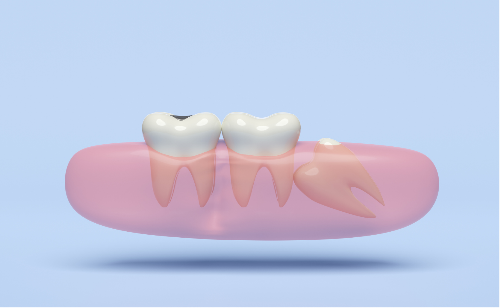 What To Expect When Getting Your Wisdom Tooth Removed | Coast Family ...